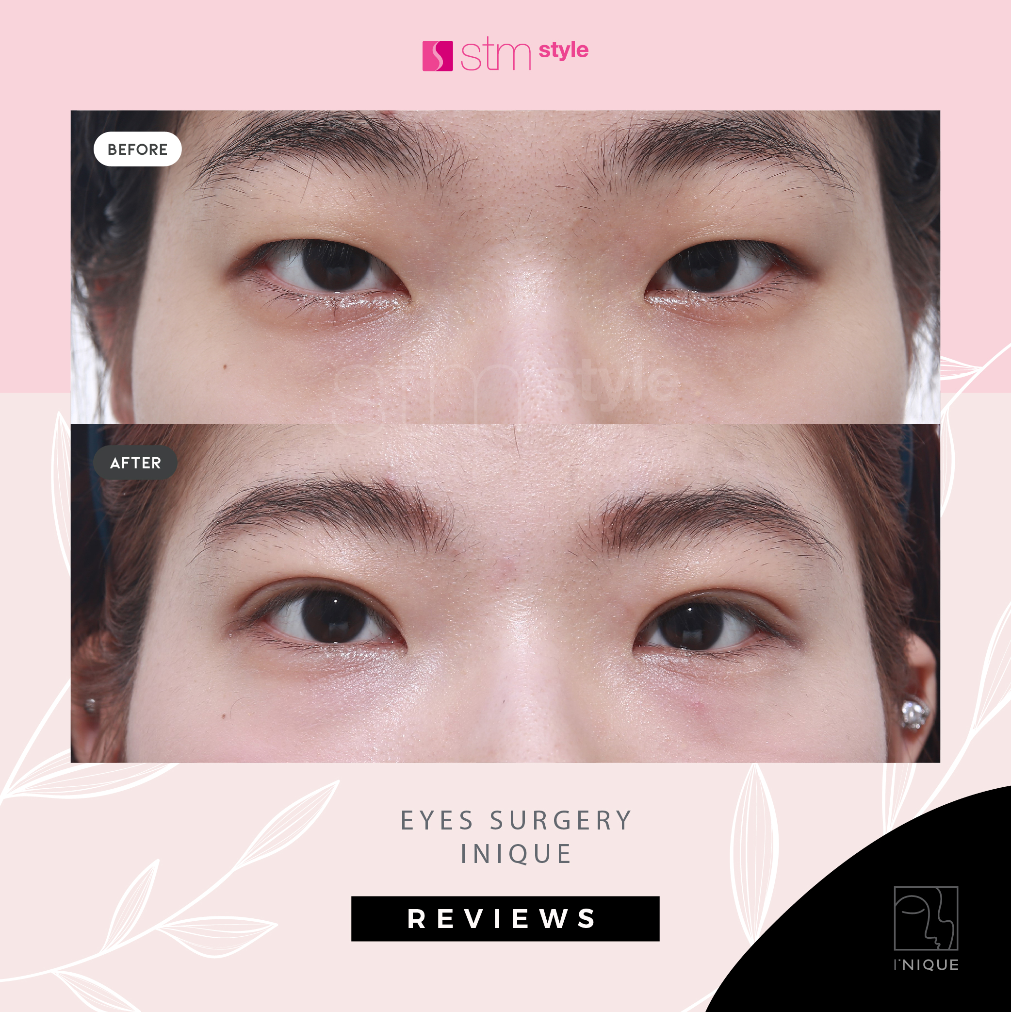 Promotion ! Opening of upper and lower eyelids (4-point) - STM Style