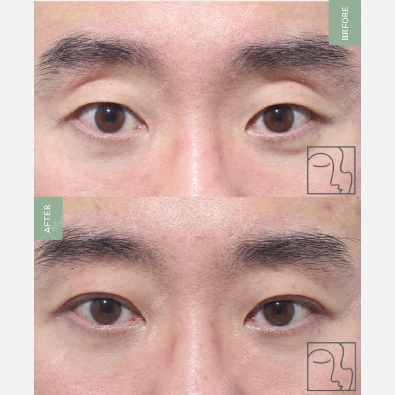 Review of Eye Correction Surgery at INIQUE Hospital. - STM Style