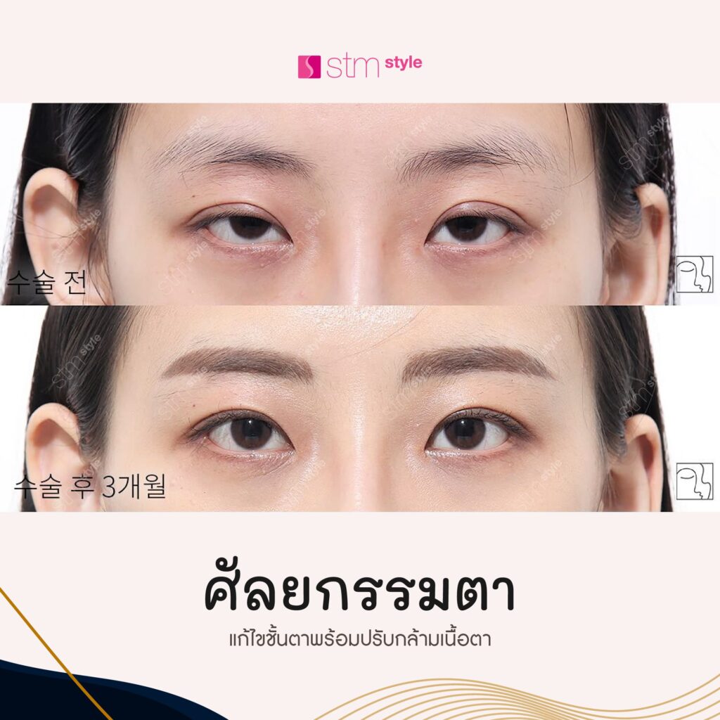 Review of Eye Surgery at Hospital IDN | Corrective Eye Surgery. - STM Style