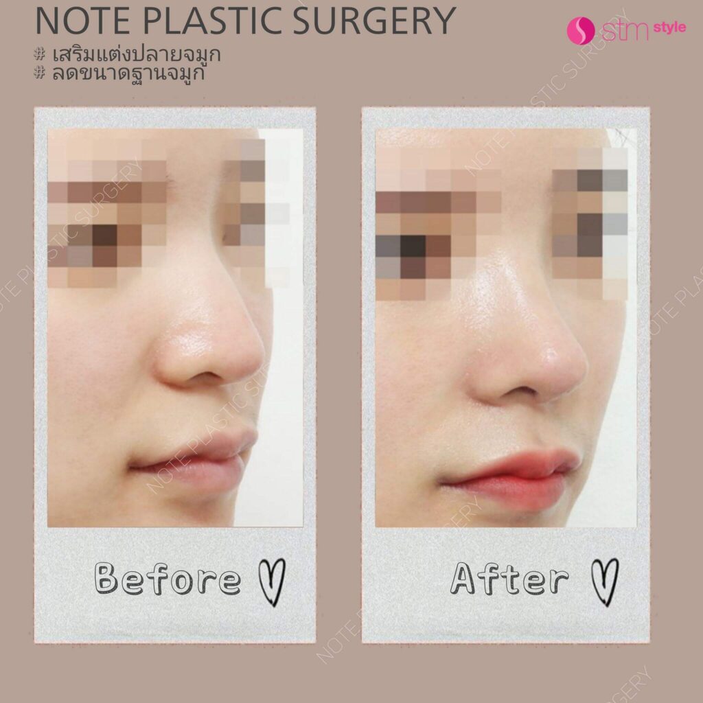 Nasal tip augmentation | Nasal base reduction | Nasal alar reduction ...