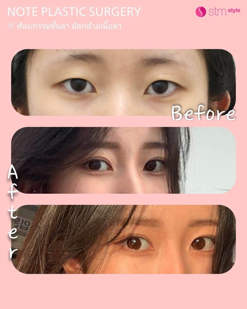 Eyelid crease surgery | Upper and lower eyelid surgery - STM Style
