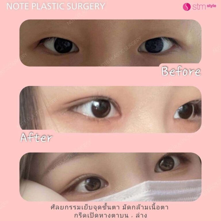 Eyelid crease surgery with eyelid muscle tightening + Upper eyelid ...