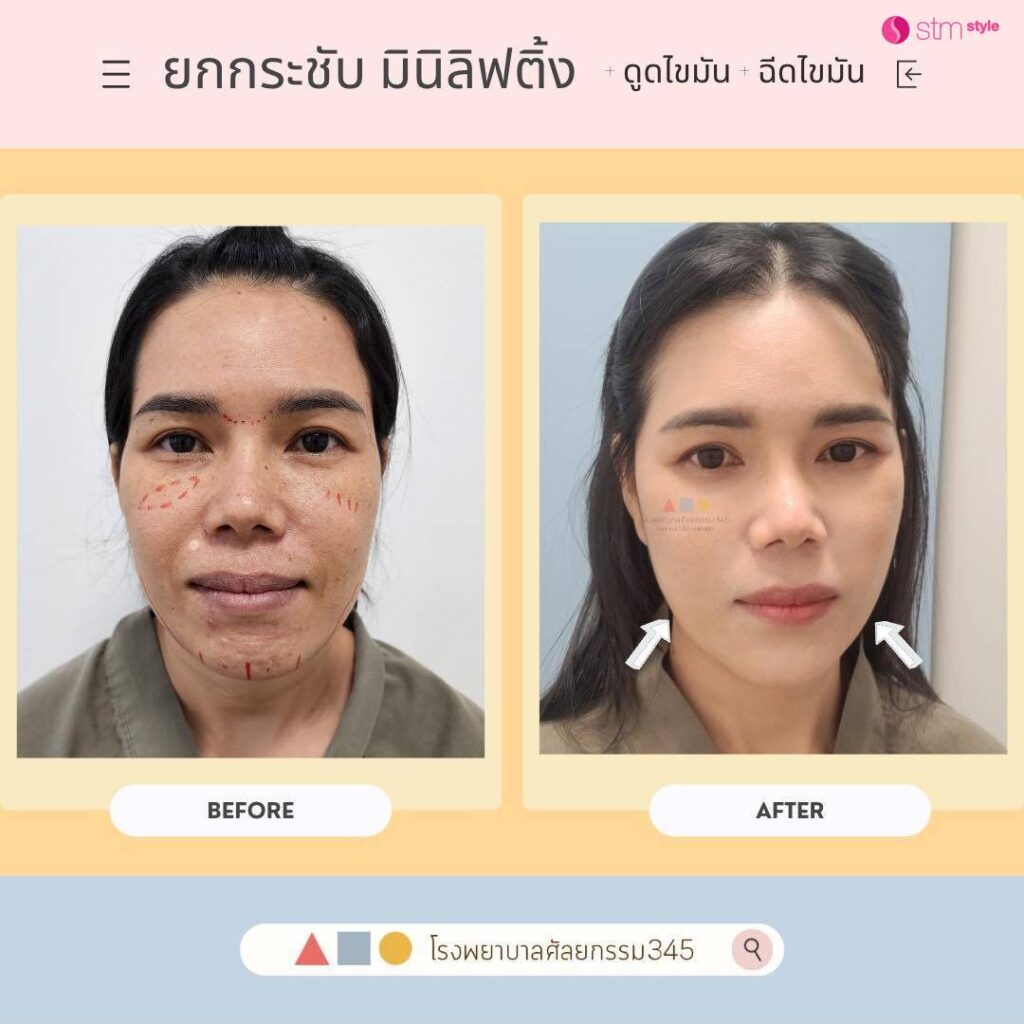 Mini Lifting - STM Style