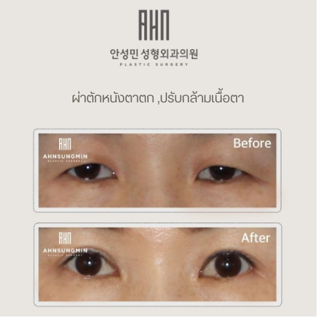 Eyelid surgery, ptosis correction - STM Style