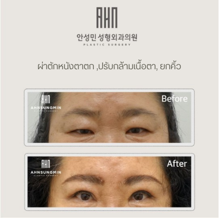 Eyelid surgery, ptosis correction - STM Style