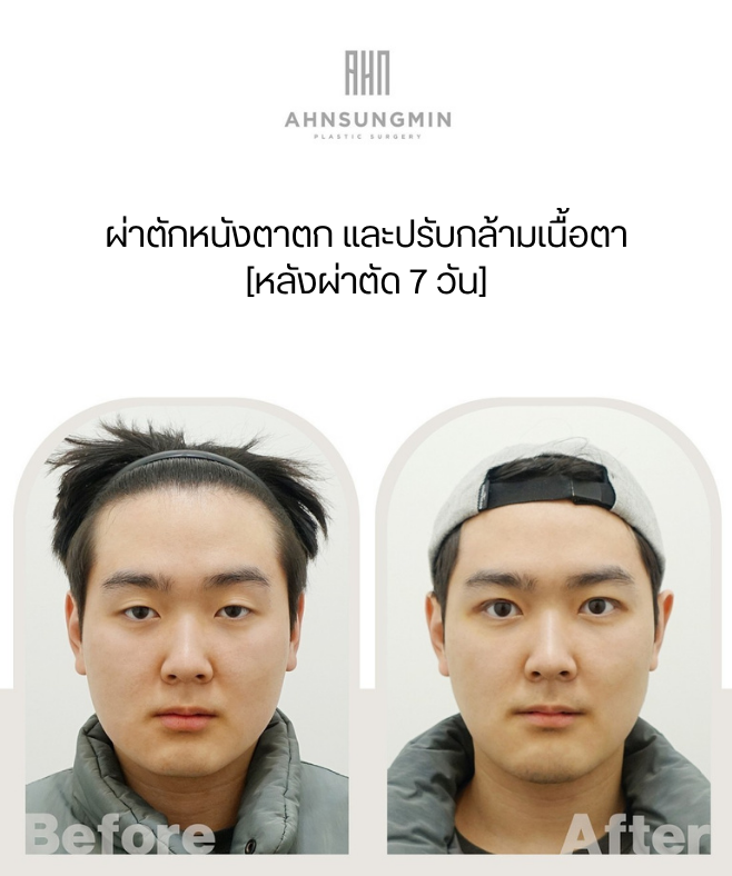 Eyelid surgery, ptosis correction - STM Style