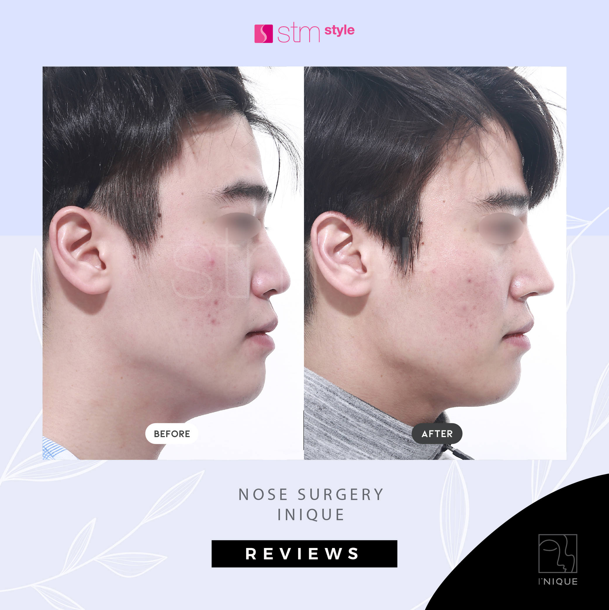 Nose surgery: Augmentation and refinement of the nasal tip. - STM Style