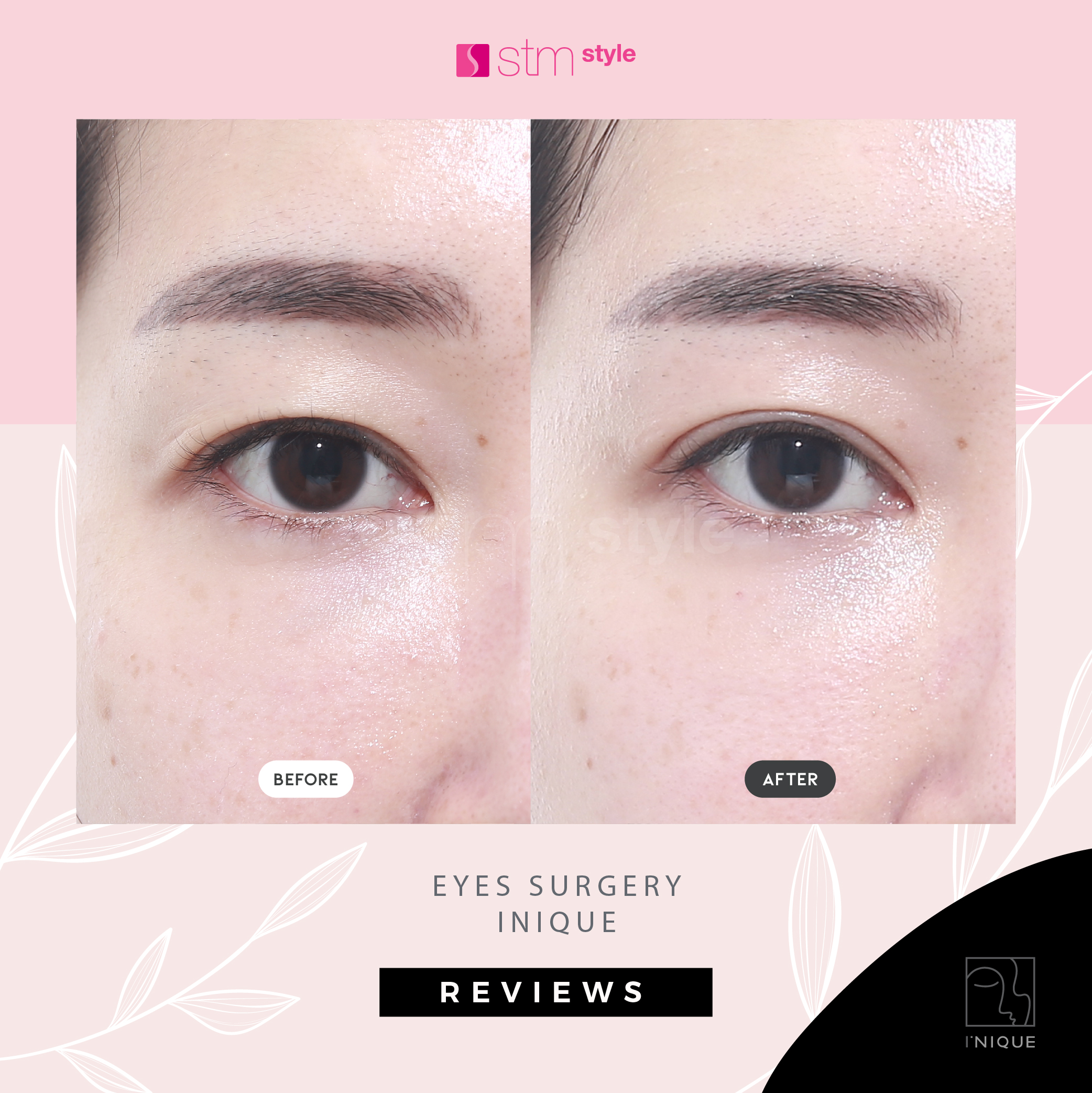 Promotion ! Opening of upper and lower eyelids (4-point) - STM Style