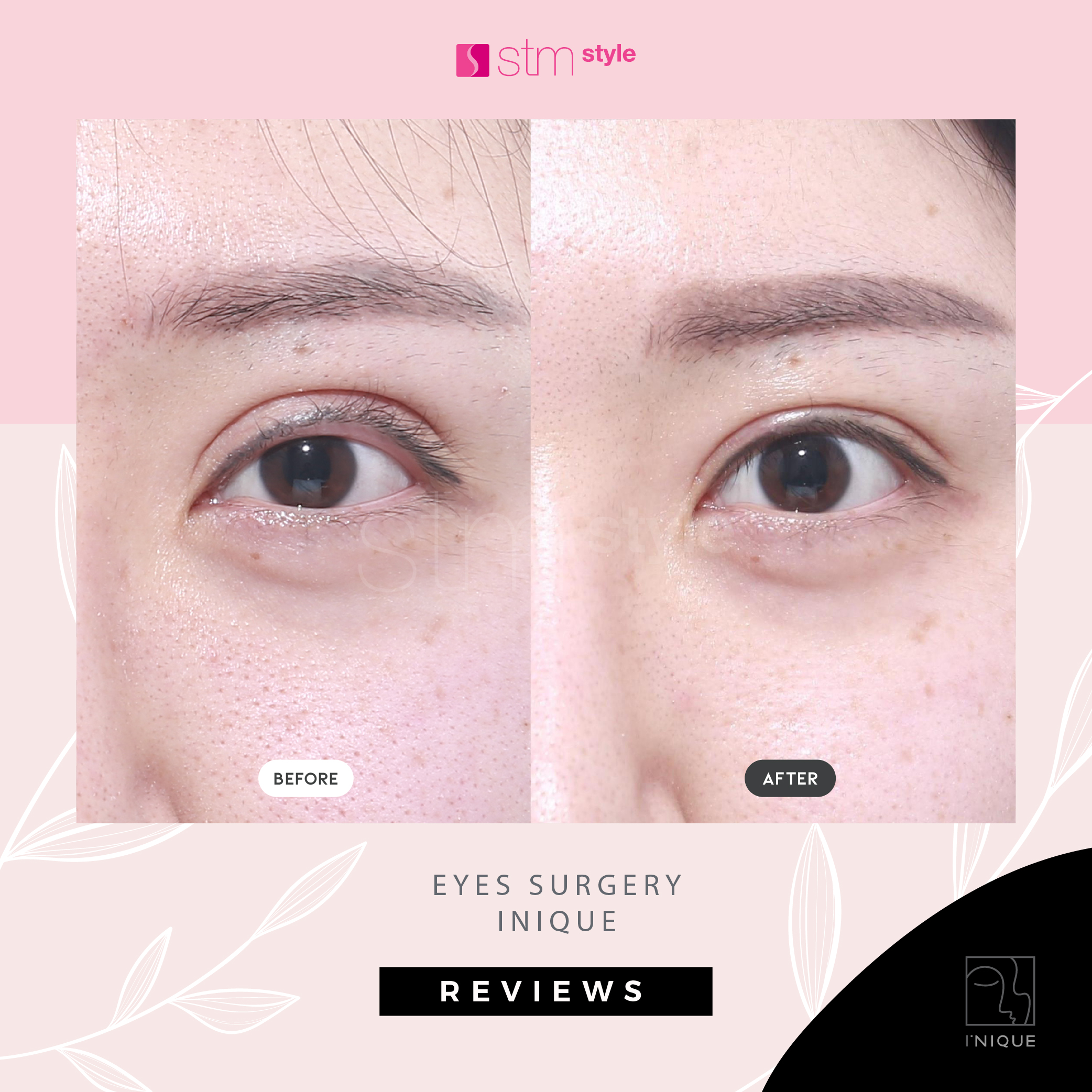 Promotion ! Opening of upper and lower eyelids (4-point) - STM Style