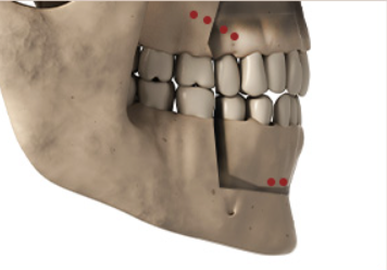 Orthognathic surgery - STM Style