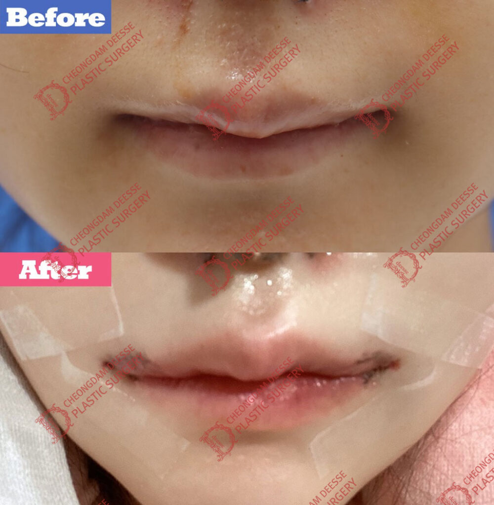 Things to know before getting chestnut lips Why do it in Korea? - STM Style