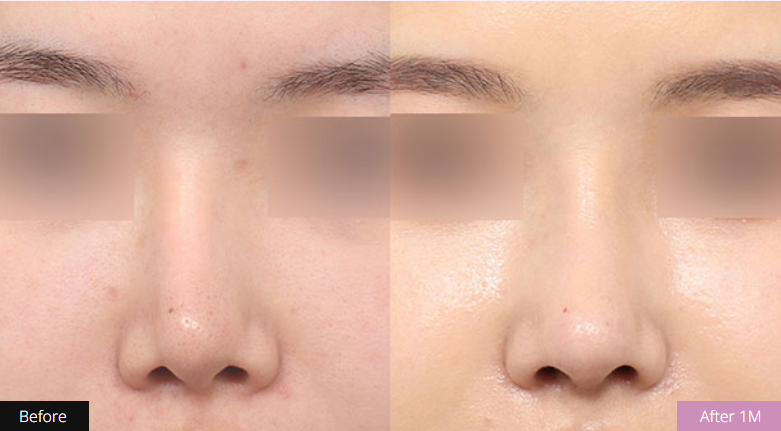 Why do you need rhinoplasty surgery? - STM Style