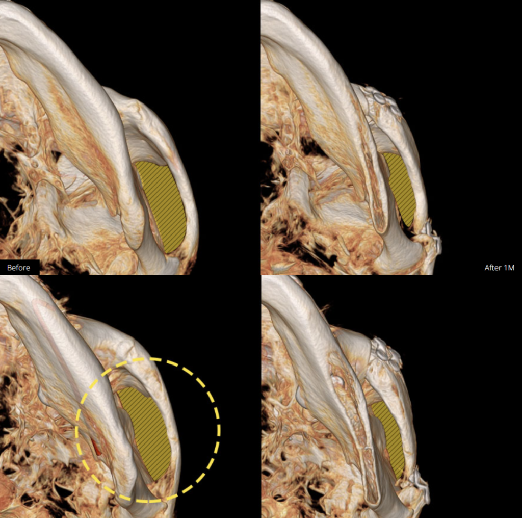 Cheekbone reduction surgery - STM Style