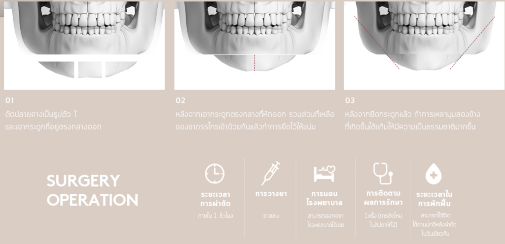 Chin surgery - STM Style