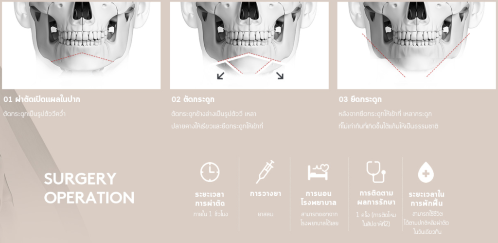 Chin surgery - STM Style