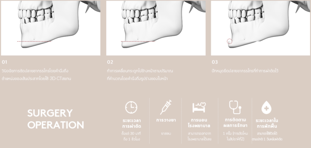 Chin surgery - STM Style