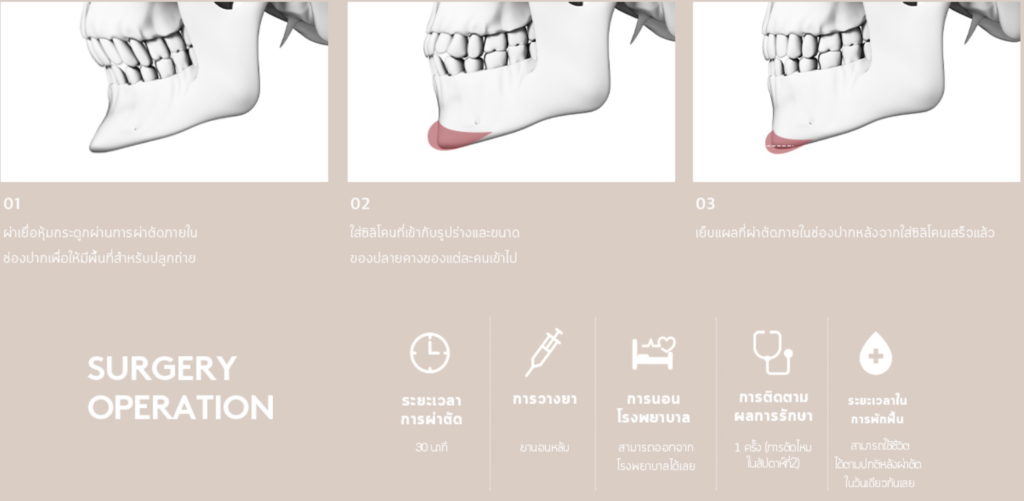 Chin surgery - STM Style