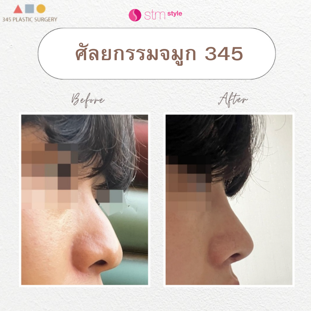 ศัลยกรรมจมูกผู้ชายโรงพยาบาล 345 - STMstyle
