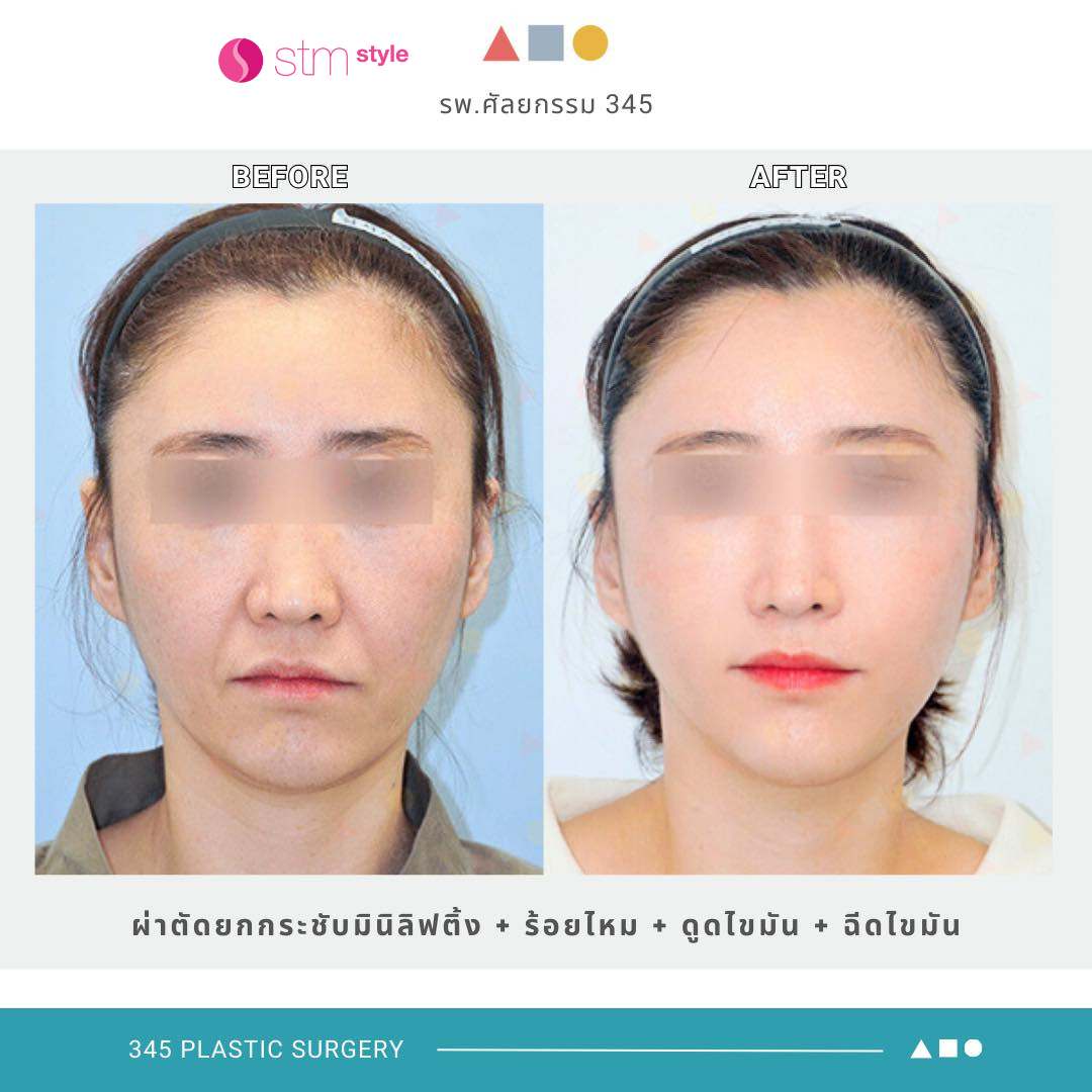 ยกกระชับโรงพยาบาล 345 - STMstyle