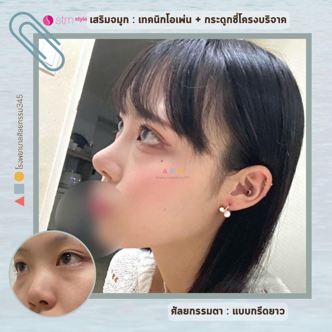 ศัลยกรรมจมูกโรงพยาบาล 345 - STMstyle