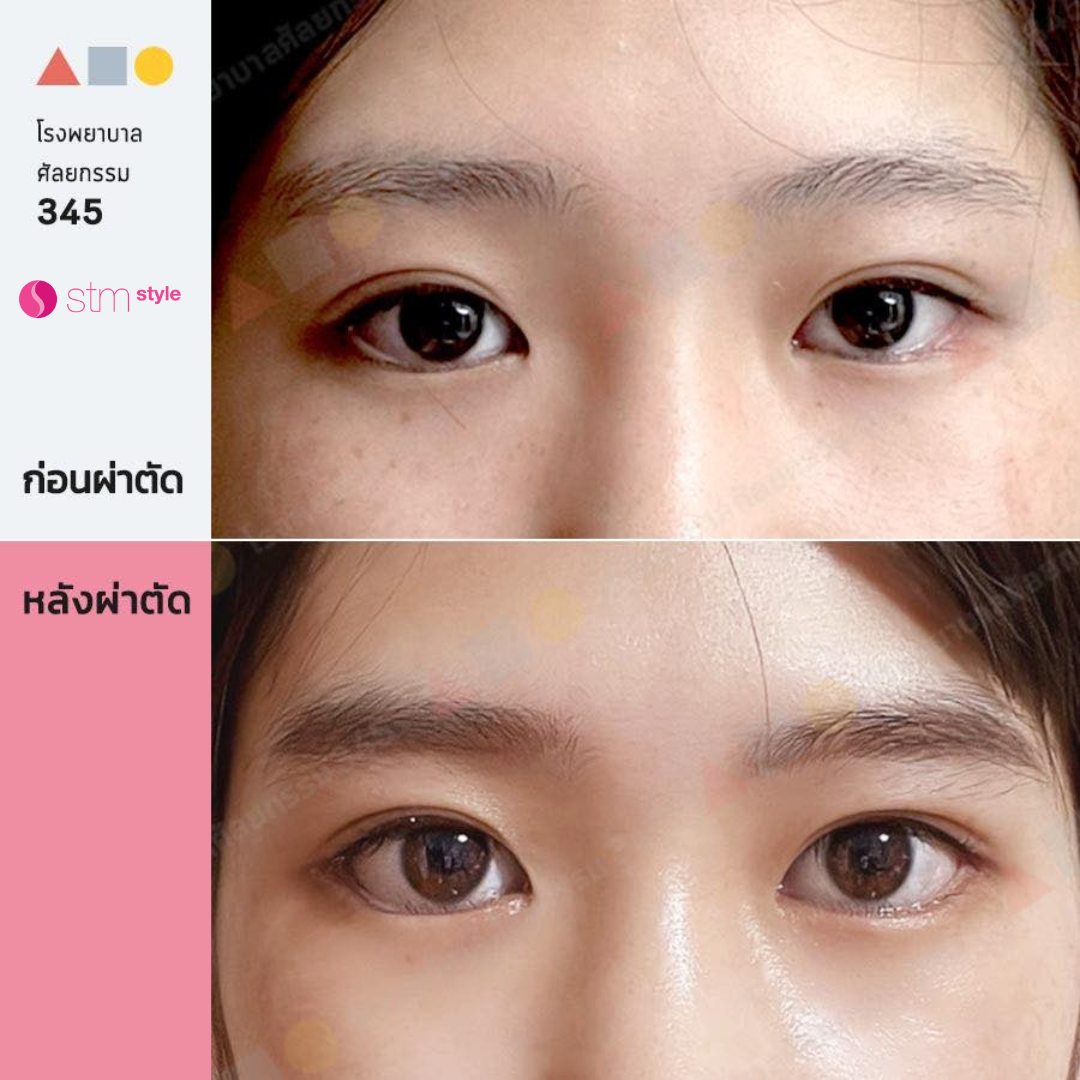ศัลยกรรมตาโรงพยาบาล 345 - STMstyle